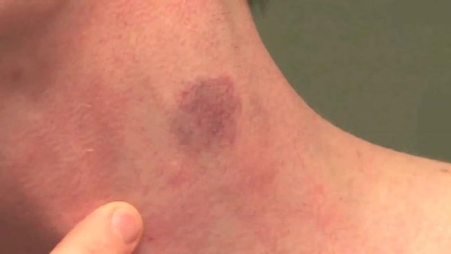 Comment enlever un suçon le plus vite possible? - Minutefacile.com