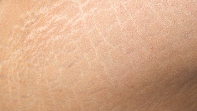 Top 10 des atuces pour éliminer les vergetures et resserrer les pores ...